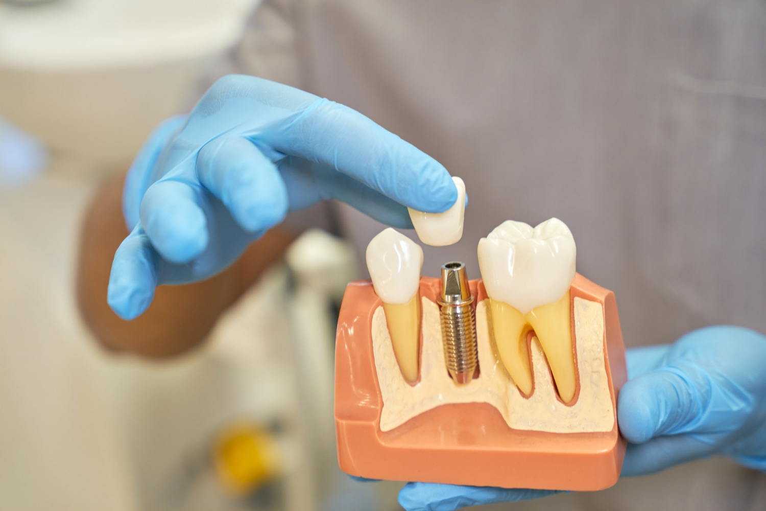 Dental Implant Restorations: Restore Your Smile with Confidence at SK ...